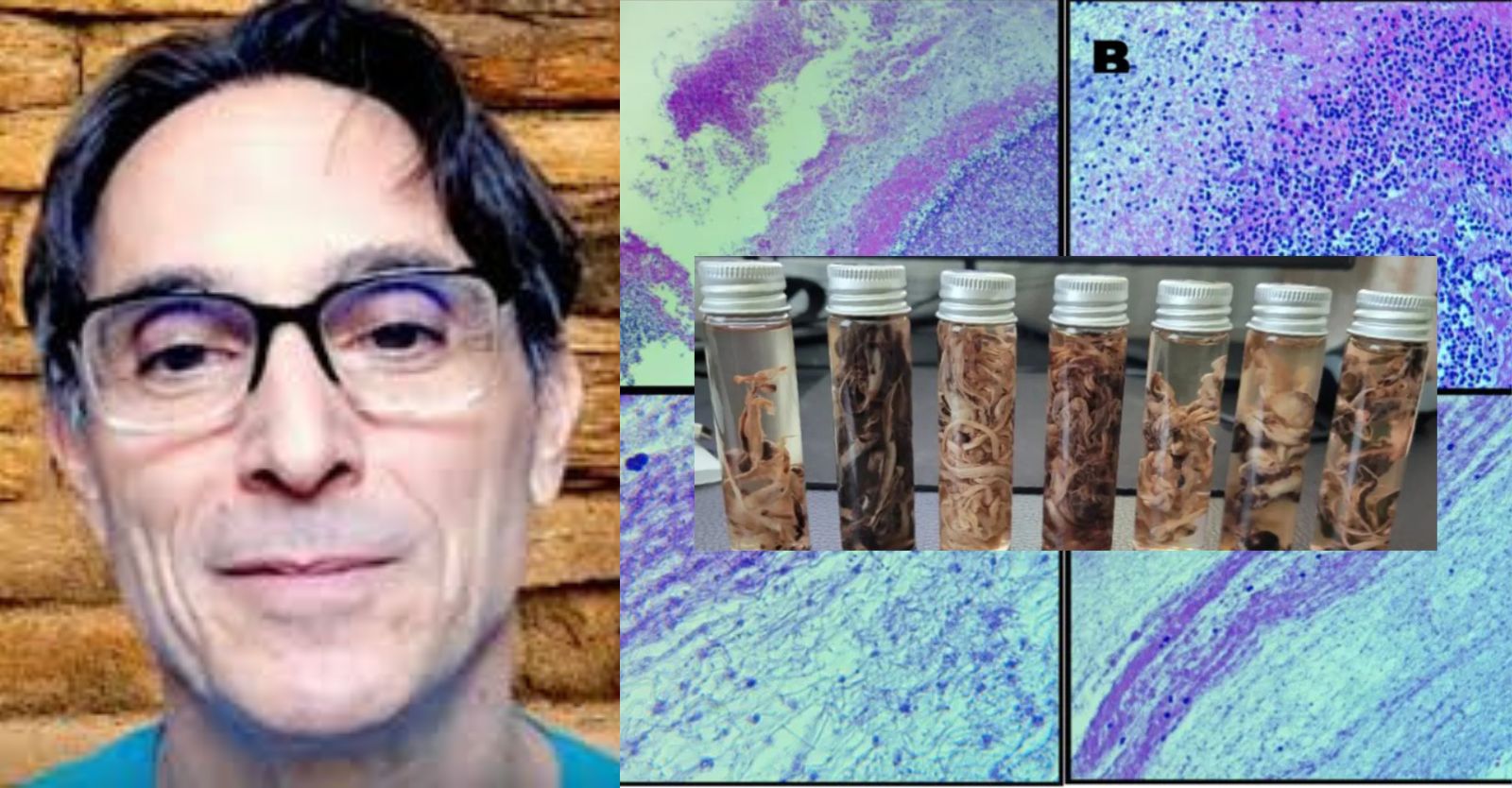 Dr. Mark Trozzi: “Calamari Clots” Unexplained Blood Structures Ignored ...