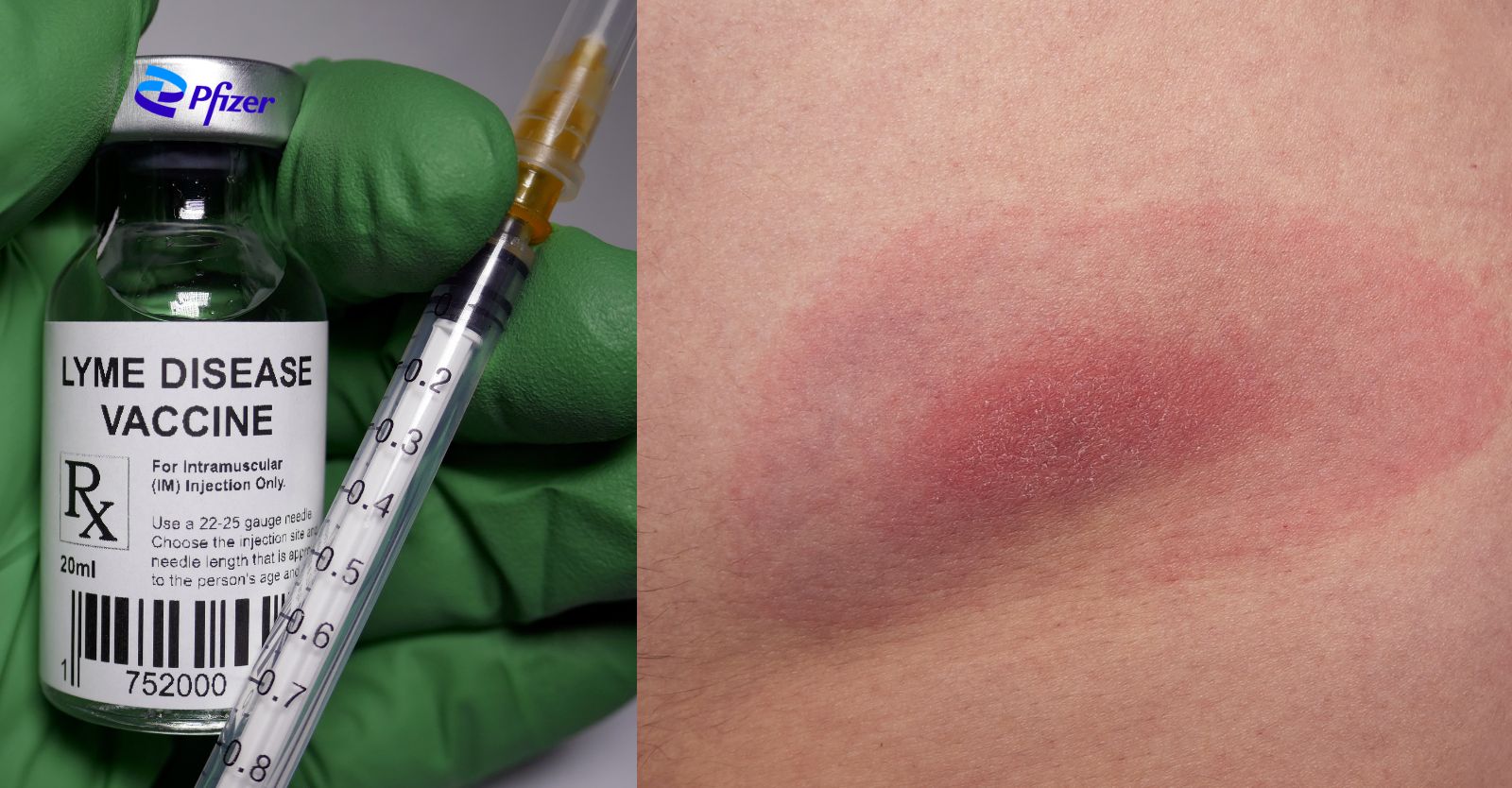 Pfizer Reboots Lyme Vaccine Linked to Autoimmune Arthritis Concerns and ...